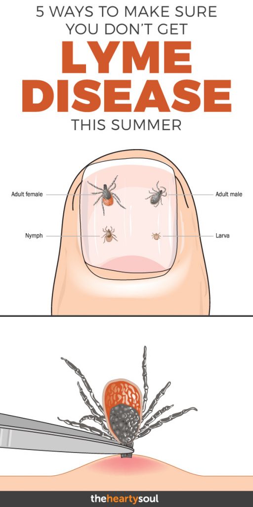 5 Ways to Prevent Lyme Disease and Tick Bites This Summer