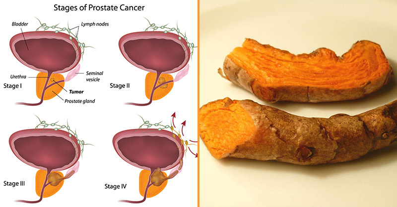 9 Foods That May Help to Reduce Prostate Cancer Risk : The Hearty Soul