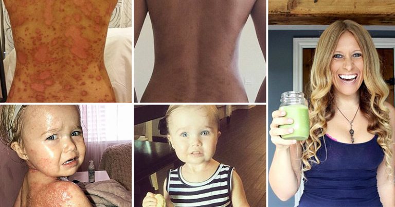 Psoriasis and Eczema Sufferer Created Diet That 'Cured Her' and is ...