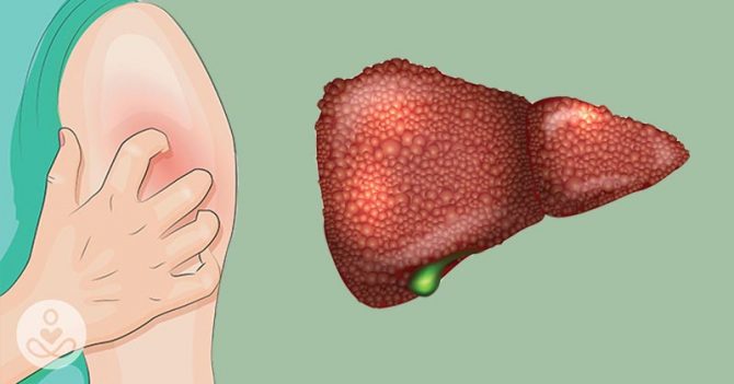 Bruise easily? Itchy skin? 5 signs you have liver damage without even ...