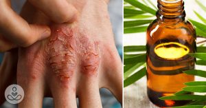 10 Tea Tree Oil Benefits For Every Skin Condition (Recipes Included)