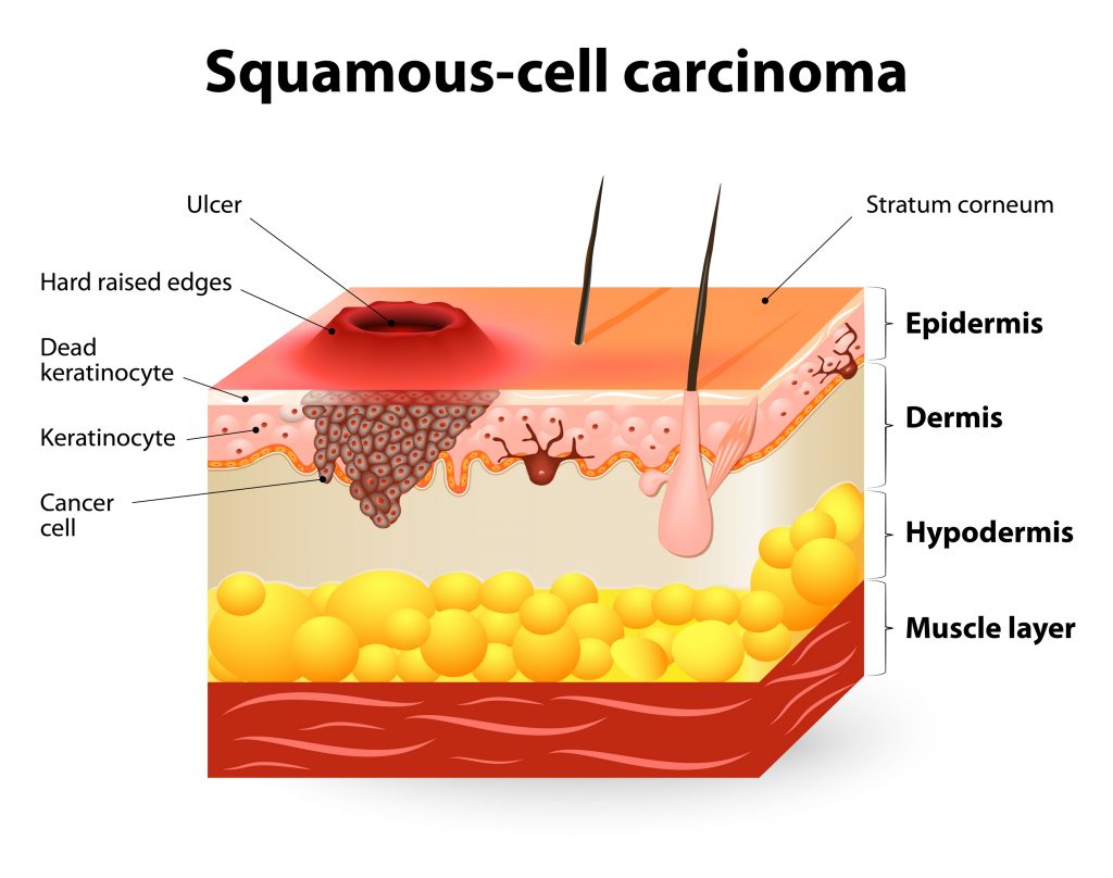 What Does Skin Cancer Look Like? Watch Out For These 7 Symptoms