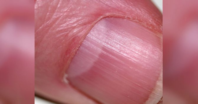 What Is Lunula? Your Lunula, Fingernails, and What They Say About Your ...