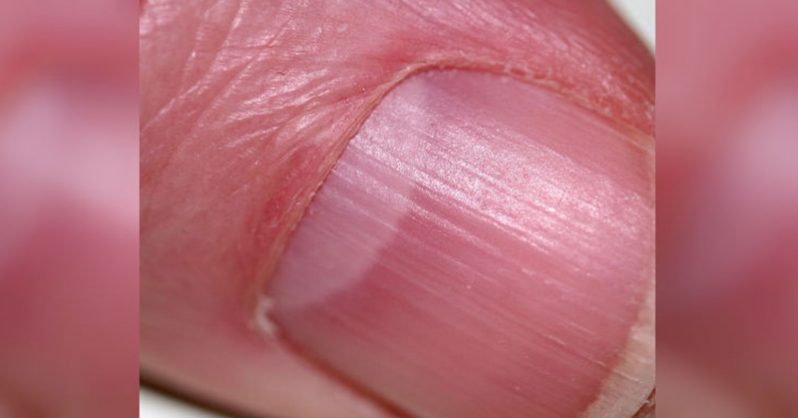 What Is Lunula? Your Lunula, Fingernails, and What They Say About Your ...