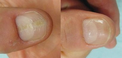 What Is Lunula? Your Lunula, Fingernails, and What They Say About Your ...