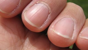 What Is Lunula? Your Lunula, Fingernails, and What They Say About Your ...