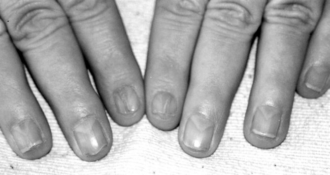 What Is Lunula? Your Lunula, Fingernails, and What They Say About Your ...