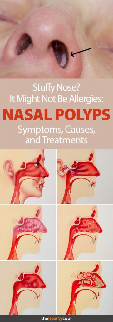 Nasal Polyps: Symptoms, Causes, and Treatments