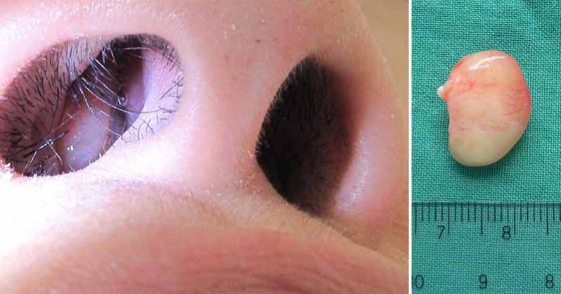 Nasal Polyps: Symptoms, Causes, and Treatments