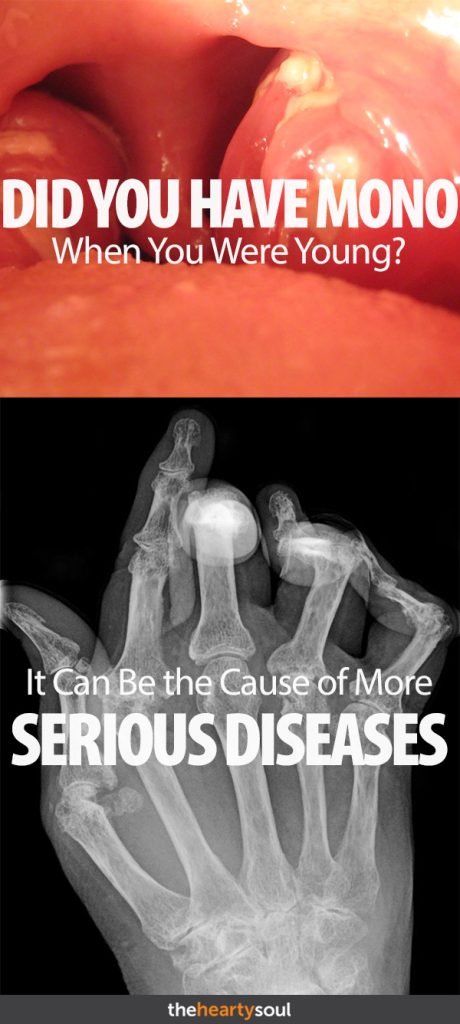 Study Links Mono Virus to Several Serious Diseases