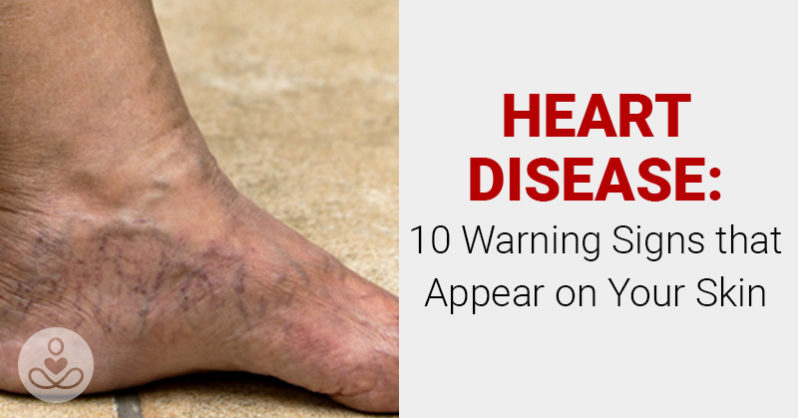 Heart Disease: 10 Warning Signs that Appear On Your Skin