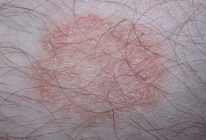 14 Rashes You Need to Know: Common Dermatologic Diagnoses