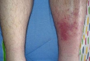 14 Rashes You Need to Know: Common Dermatologic Diagnoses