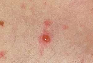 14 Rashes You Need to Know: Common Dermatologic Diagnoses