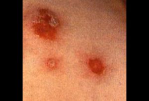 14 Rashes You Need to Know: Common Dermatologic Diagnoses