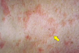 14 Rashes You Need to Know: Common Dermatologic Diagnoses