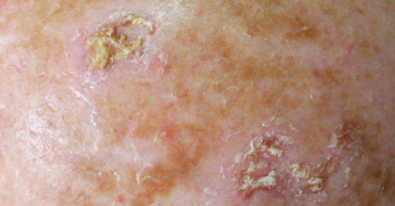 Close Up Images Of Each Type Of Skin Cancer