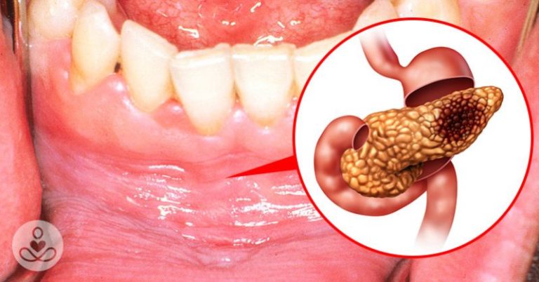 Gum disease and cancer connected in a 10-year study : The Hearty Soul