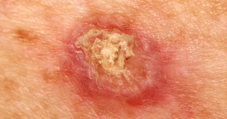 Close Up Images Of Each Type Of Skin Cancer