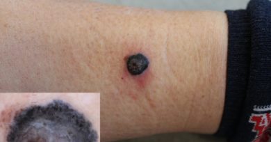 Close Up Images Of Each Type Of Skin Cancer
