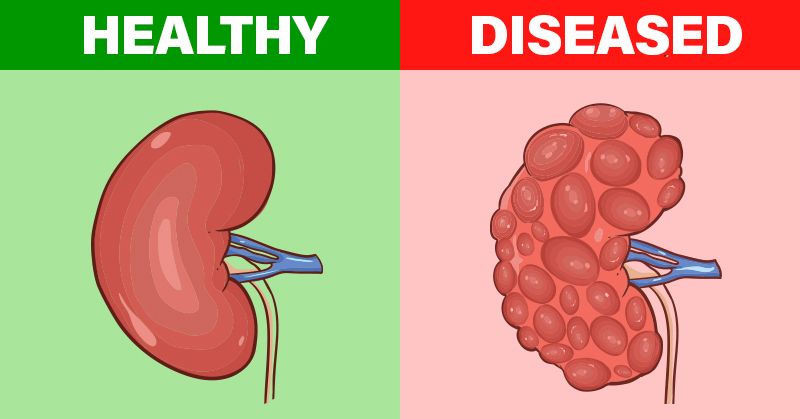 9 common habits that cause kidney damage