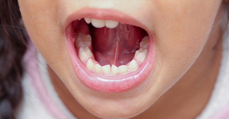 Rapid evolution means humans now being born without wisdom teeth