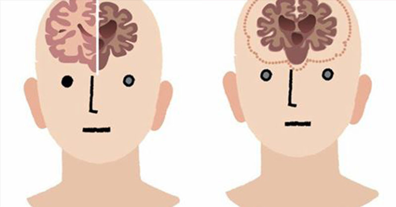 12 Early Warnings Signs Of Dementia The Hearty Soul