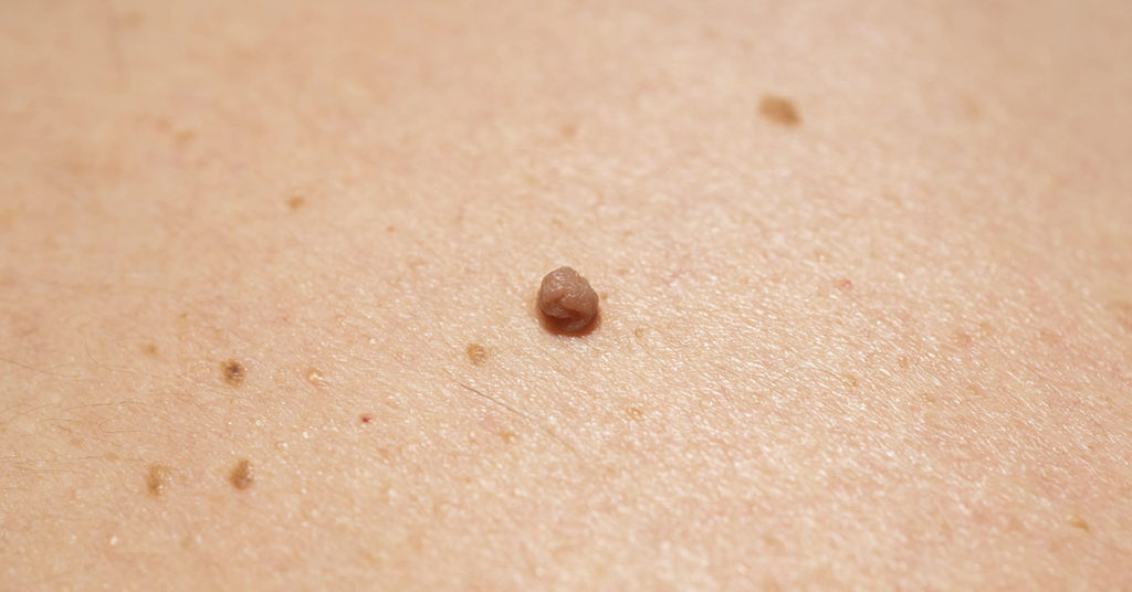 Natural Skin Care: What Can You Try To Remove Age Spots, Moles, Skin ...