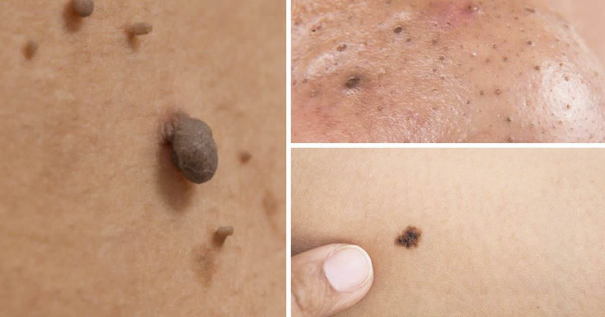 Natural Skin Care: What Can You Try To Remove Age Spots, Moles, Skin ...