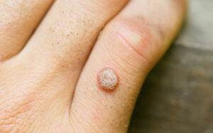 Natural Skin Care: What Can You Try To Remove Age Spots, Moles, Skin ...