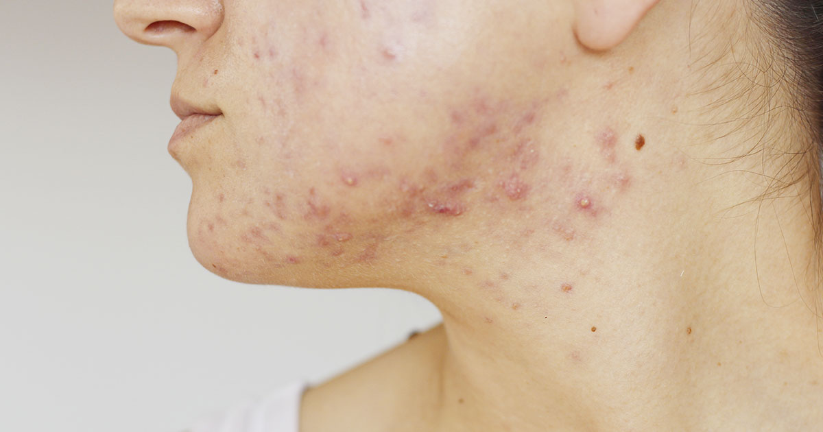 Do Vitamin B12 Supplements Cause Acne, Bone Fractures, and Lung Cancer?