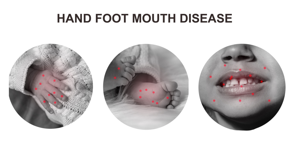 7 Warning Signs of Hand-Foot-and-Mouth Disease Parents Should Look Out For