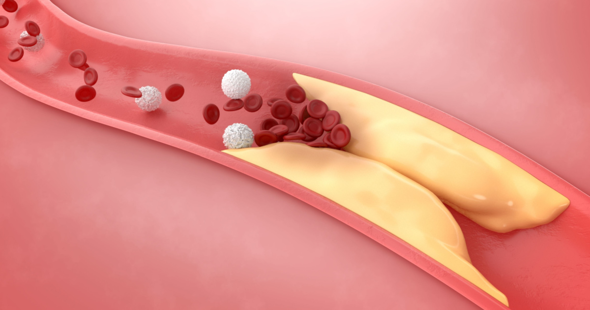 6 Early Warning Signs Of A Blood Clot
