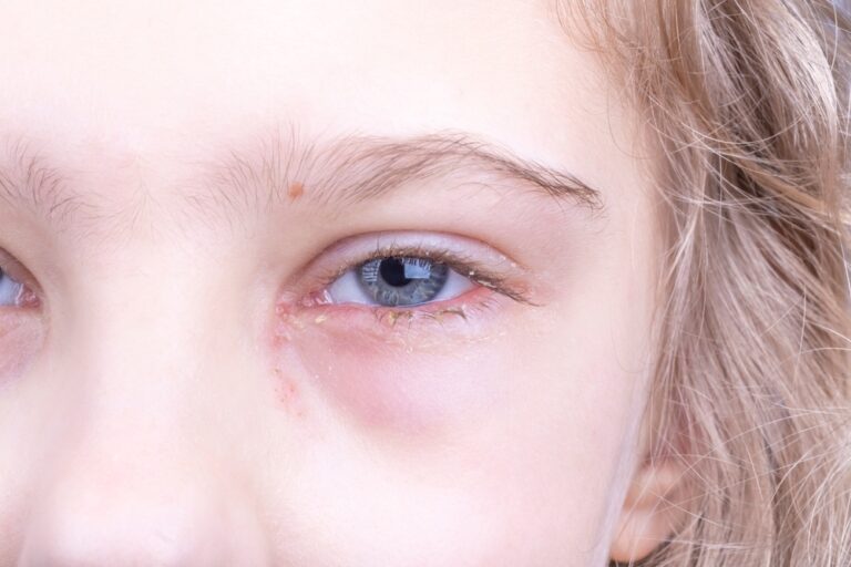 What is Sleep Crust and Where Does it Come From?