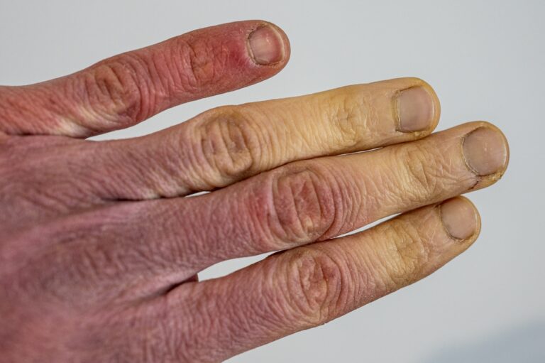 Rare Disorder Can Turn Fingers, Toes White or Blue When it's Cold
