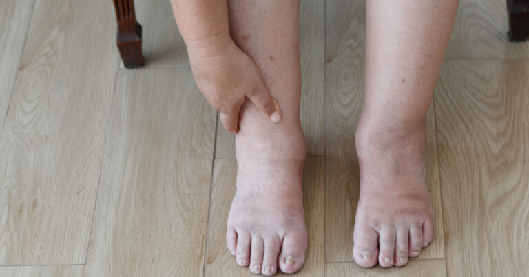 10 Swollen Feet Causes + When To See Your Doctor