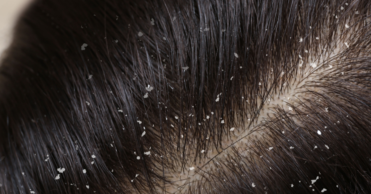 8 Vitamin Deficiencies That Show Up On Your Skin