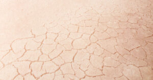 8 Vitamin Deficiencies That Show Up On Your Skin