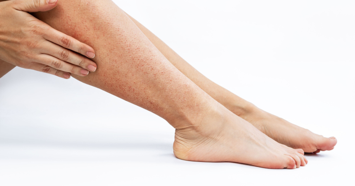 10 Tea Tree Oil Benefits For Every Skin Condition (Recipes Included)