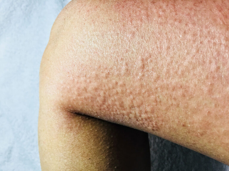 Cold Urticaria: Symptoms, Causes, and How to Treat Being Allergic to Cold