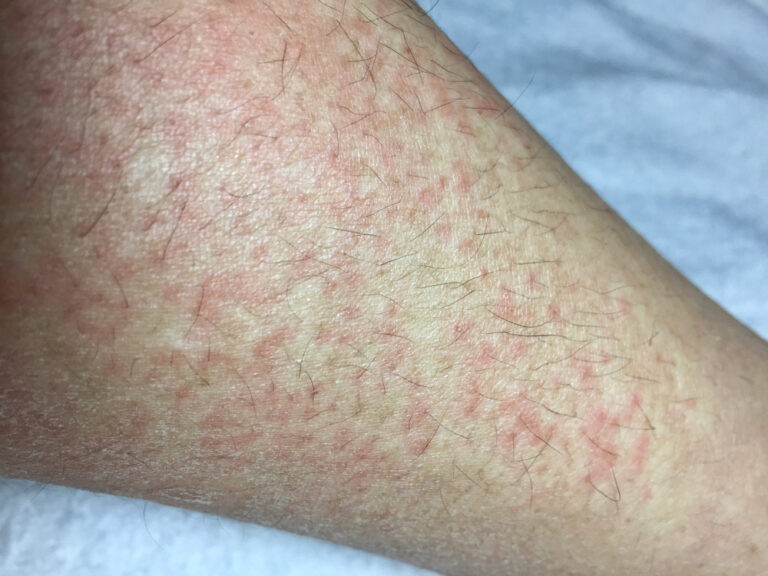 Cold Urticaria: Symptoms, Causes, and How to Treat Being Allergic to Cold