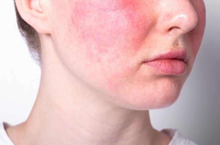 Face Red When Drinking? Study Finds You May Be Prone To Alzheimer's