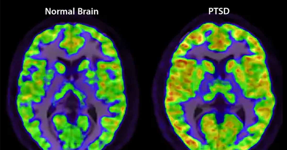 14 Conditions That Drastically Change Your Brain