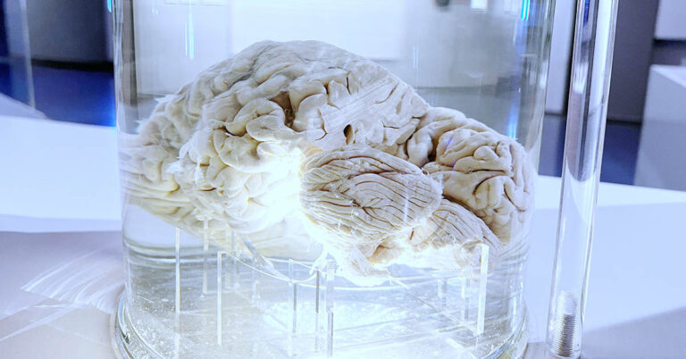 Brain Autopsies Show Possible Culprit Behind Alzheimer’s Disease