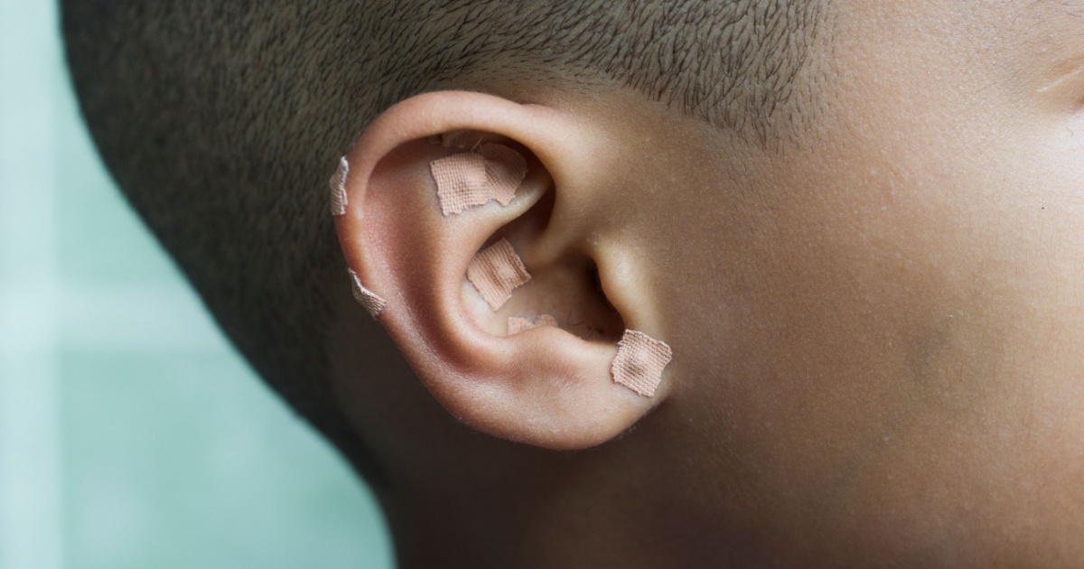 Ear Seeds: What Are They, And Do They Work?