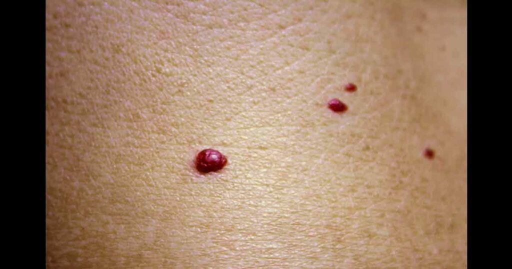 11 Reasons Why You Have Red Dots On Your Skin Daily N