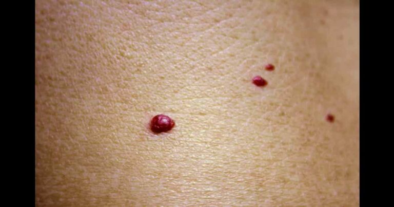 11 Reasons Why You Have Red Dots On Your Skin