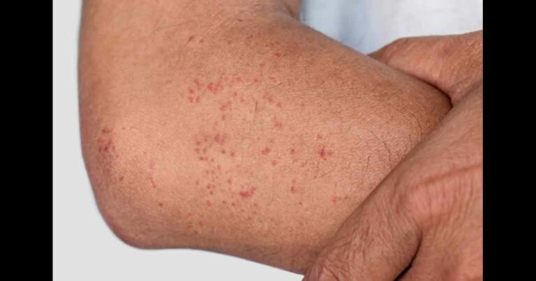 11 Reasons Why You Have Red Dots On Your Skin