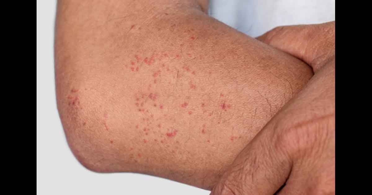 11 Reasons Why You Have Red Dots On Your Skin Rezept
