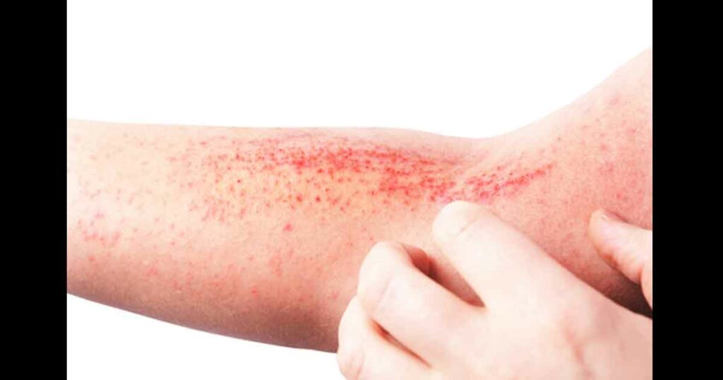11 Reasons Why You Have Red Dots On Your Skin Daily N 11 Reasons Why You Have Red Dots On Your Skin Daily N